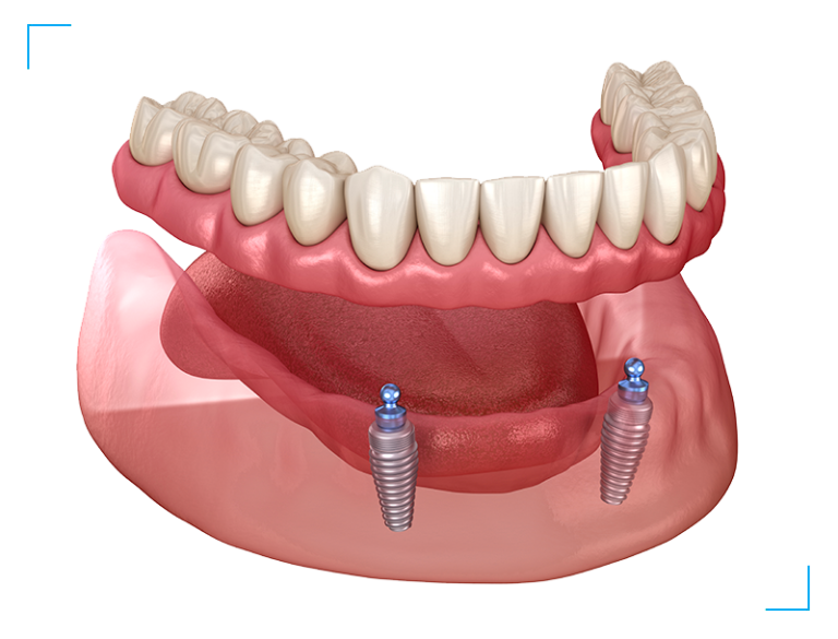 Implant dentaire au cabinet de chirurgie orale - Nîmes